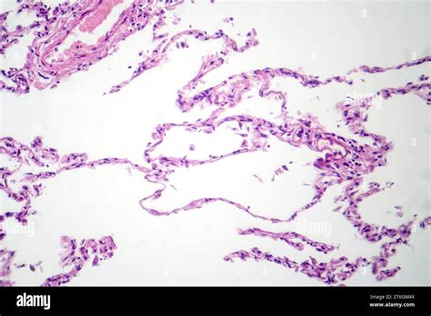 Photomicrograph Of Diffuse Emphysema Revealing Damaged Lung Tissue