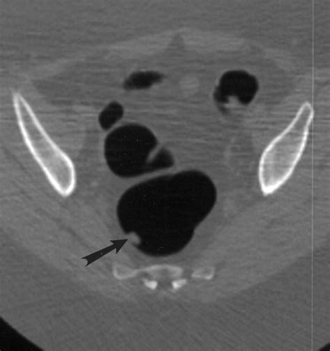 Imaging In The Diagnosis Staging And Follow Up Of Colorectal Cancer Ajr