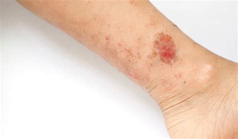Is Varicose Eczema Dangerous Vein Solutions