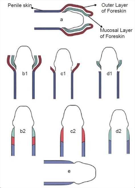 Different Types Of Circumcision Procedures At Will Hannah Blog