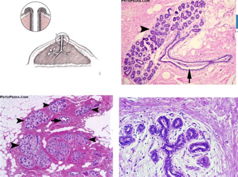 Breast Neoplasms Flashcards Quizlet