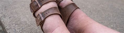 Anasarca Causes Symptoms Diagnosis And Treatment