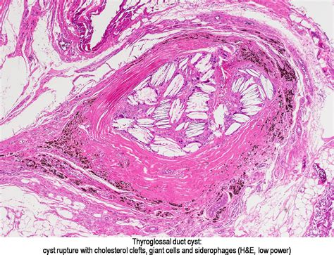 Thyroid Gland Congenital Anomalies Thyroglossal Duct Tgd Cyst ~ Phan