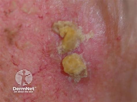 Actinic Keratoses Affecting The Face Images
