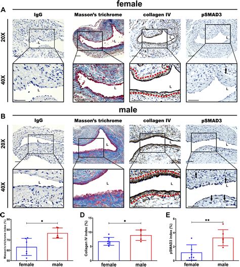 Effect Of Sex Differences In Treatment Response To Angioplasty In A