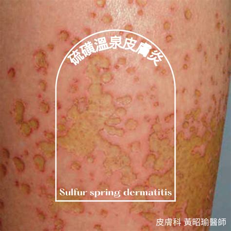 冬季皮膚炎｜ 溫泉♨️熱水皮膚炎