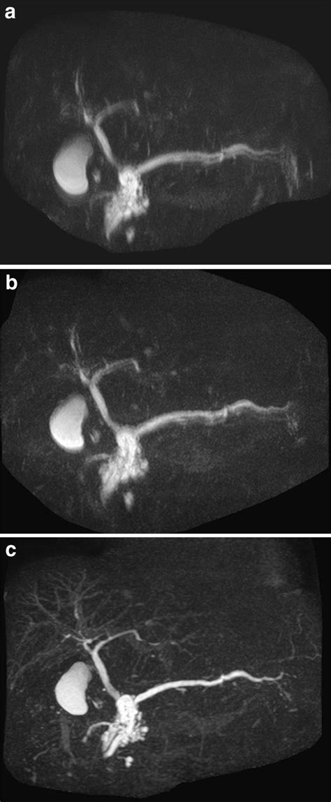 A 72 Year Old Man With Branch Duct Intraductal Papillary Mucinous