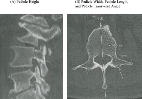 Measurements Of Each Parameter On Ct Images A Pedicle Height B Download Scientific Diagram