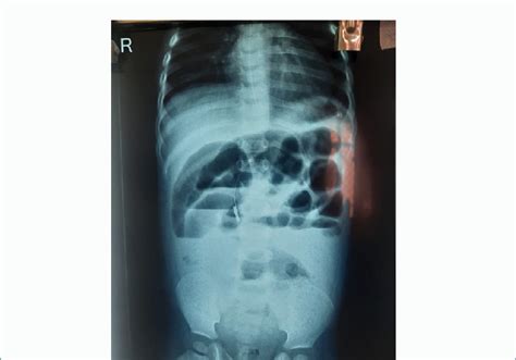 X Ray Abdomen Erect Multiple Air Fluid Level Suggestive Of Intestinal