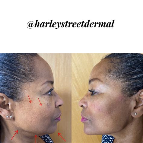 What Is Cheek Enhancement Harley Street Dermal