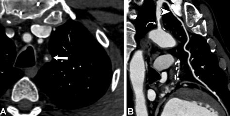 Subclavian Artery Anatomic Review And Imaging Evaluation Of