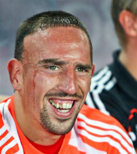 Franck Ribery Images Teeth Key Topics In Restorative Dentistry