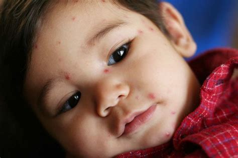 Varicella Sintomi Durata E Cure Nanopress
