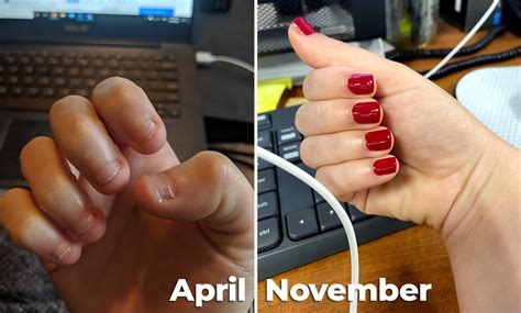 After 31 Years Of Chronic Nail Biting I Finally Kicked The Habit