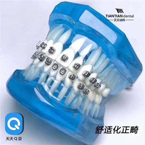 Orthodontic Band Orthodontic Brackets Mbt System Oral Braces Self Ligating Roth Mbt 0 022 345