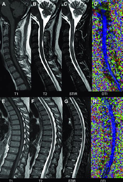Multiple Sclerosis Demyelinating Plaques Can Be Detected As Diffuse