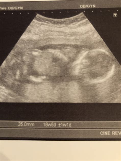 Ultrasound Thread Page 3 — The Bump