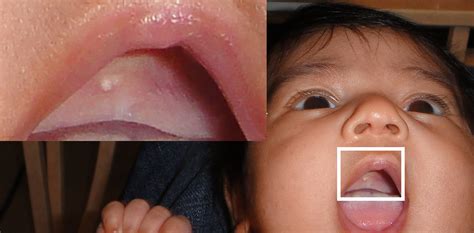 Epstein Pearls Definition Traits Causes Treatment