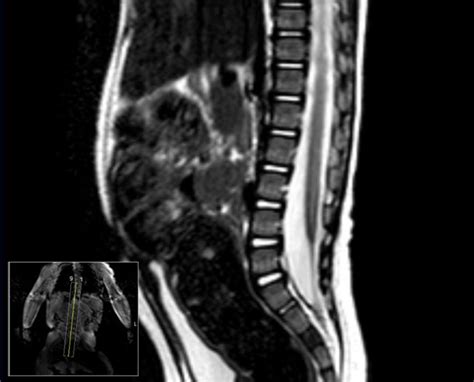 Spina Bifida Mri