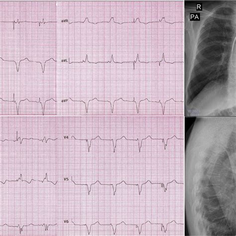 Twelve Lead ECG And Chest X Ray PA And Lateral Views Of A Patient