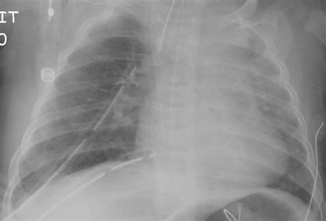 An Idiopathic Congenital Chylothorax Surgery Or Conservative Management BMJ Case Reports