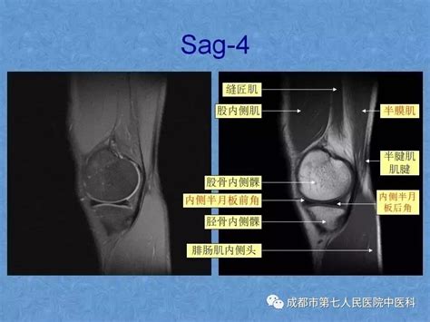 影像解剖 膝关节MRI高清解剖图解 膝关节 粘液样 解剖 健康界
