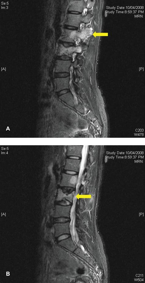 Metastatic Follicular Thyroid Carcinoma As A Cause Of Low Serum Thyroxine With A Normal Thyroid