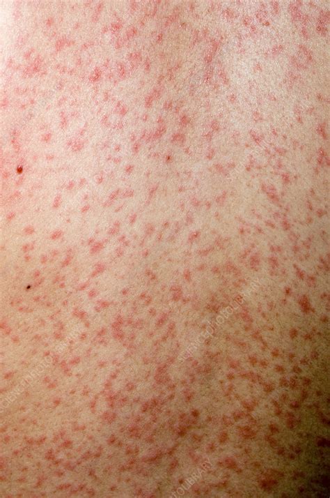 Measles Rash Stock Image M210 0361 Science Photo Library