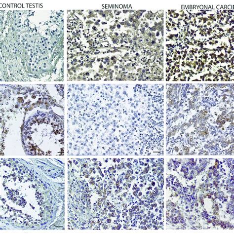 Representative Immuno Stains A Pax8 B Pin4 C Psa D Psap E