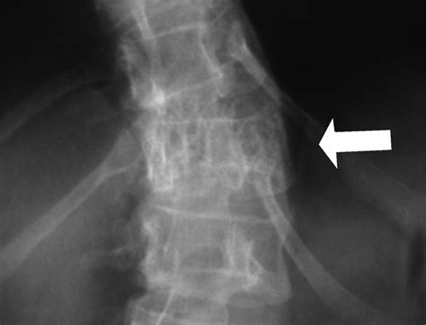 Hemangioma Vertebral Reemo