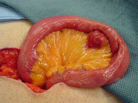 Small Bowel Tumor Gist 4059 Small Bowel Neoplasm Gist 2 1 Surgery Photos