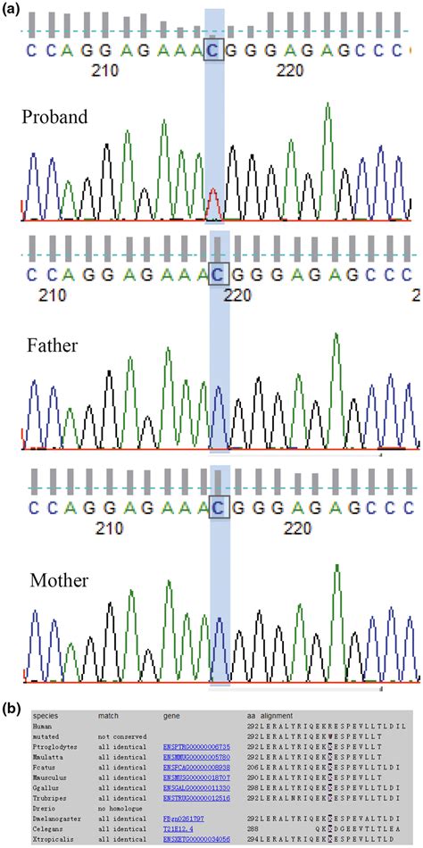 Sanger Sequencing Of Dync1h1 Variants In The Infant And Her Healthy