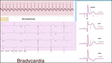 Cardiac Function Tests Pptx