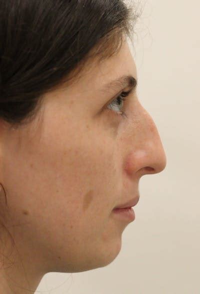 Deviated Septum Repair Before And After Photos Klausner Institute