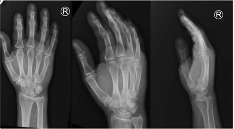 Right Hand Radiographs Showing Soft Tissue Swelling Extending To The Download Scientific