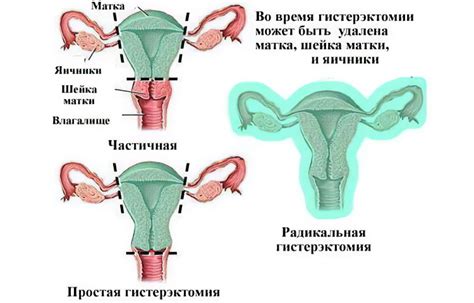 Опущение матки последствия: Выпадение и опущение органов малого таза ...