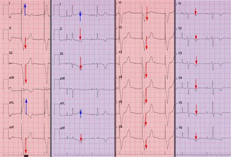 Ekg Kazuistika T Wave Memory Kardioblog