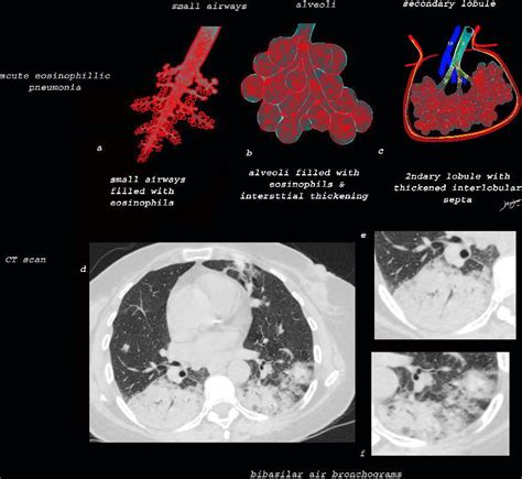 Diagrams Eosinophilic Pneumonia Lungs