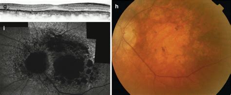 The Pattern Dystrophies Ento Key