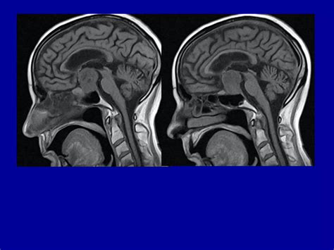 Mri Case Discussion Macroadenoma Neurogenic Spinal Tumors Spinal
