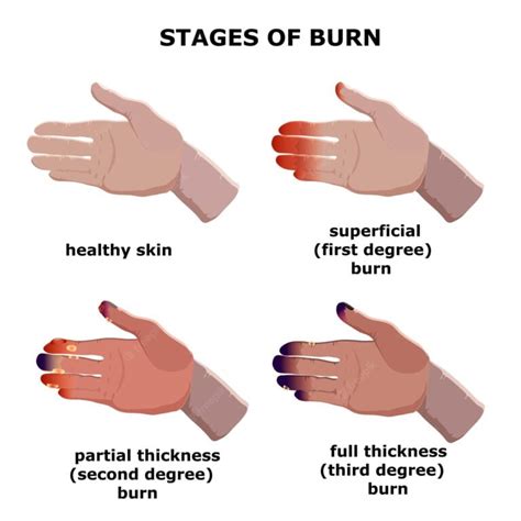 Burn Types Treatment And Nursing Management Medical Surgical
