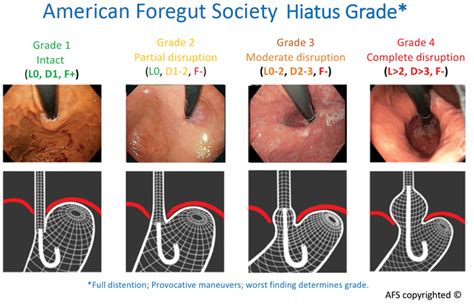 Hiatal Hernia Missed On Endoscopy At Clifton Morin Blog