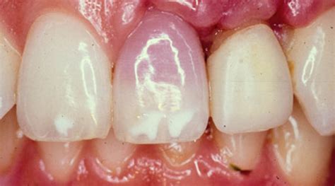 White Gum Infection