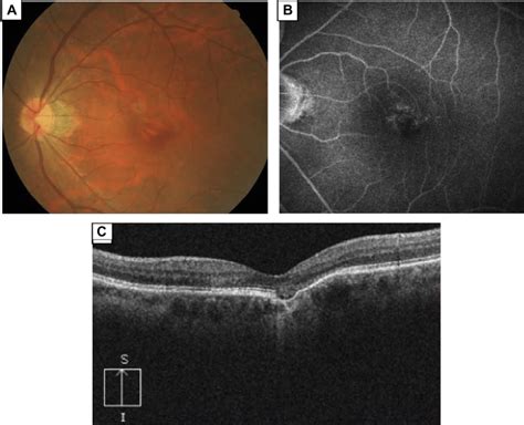 Group 3 Focal Foveal Atrophy In Patient 18 A Color Fundus