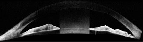 Angle Closure Glaucoma Detection And Interventions Glaucoma Australia