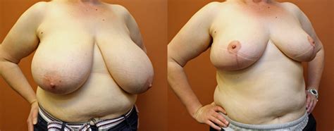 When Is A Breast Reduction Medically Necessary Dr Lim