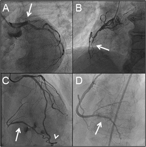 The Risk Of A Non Ira Cto In A Patient With Acs A Stemi Patient With