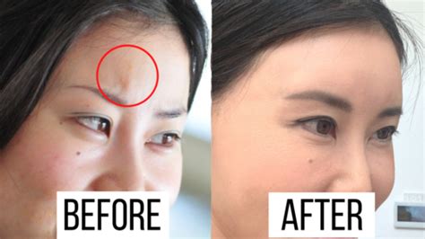 Eliminate 11th Frown Lines Between Eyebrows Koko Face Yoga