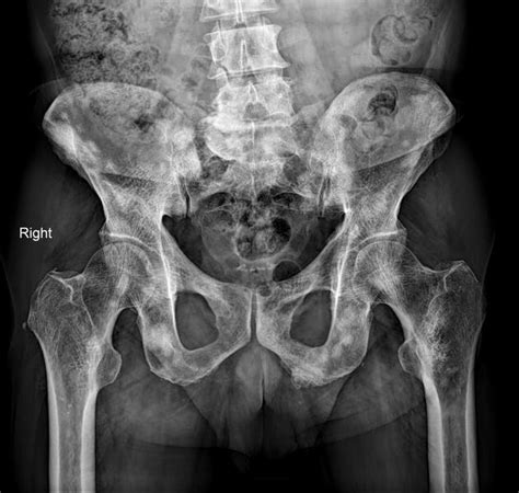 Osteoblastische Knochenmetastasen Pacs