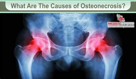 Osteonecrosis Treatments What Works Best